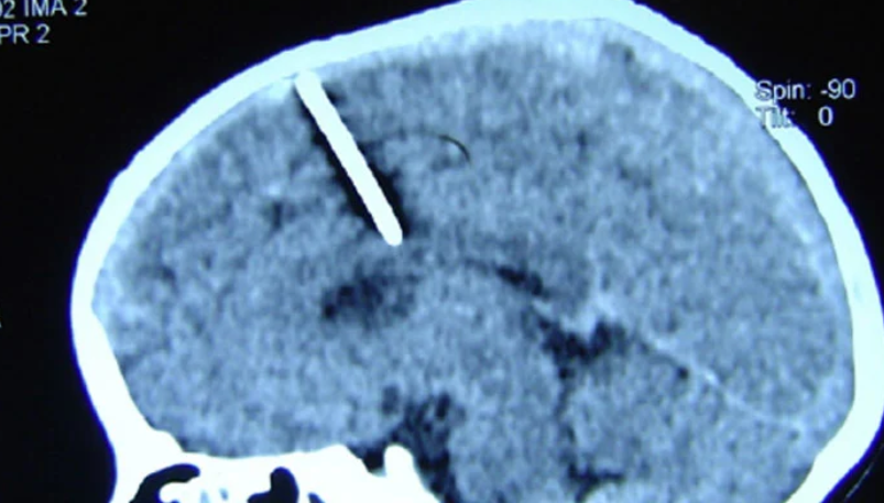 For 80 years he lived with a needle stuck in his brain - Jurnal Time